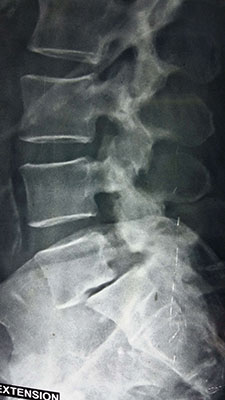 Dr. Saikat Sarkar - Orthopaedic Spine Surgeon