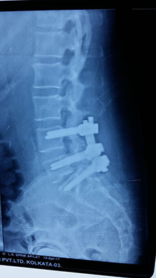 Dr. Saikat Sarkar - Orthopaedic Spine Surgeon